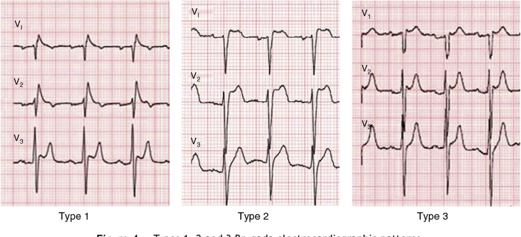 Sindrome di Brugada - Cardiologia D'Ascia